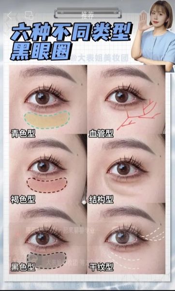 女人黑眼圈严重说明什么_黑眼圈严重怎么办-第3张图片-山城妙识 女人黑眼圈严重说明什么_黑眼圈严重怎么办-第3张图片-山城妙识