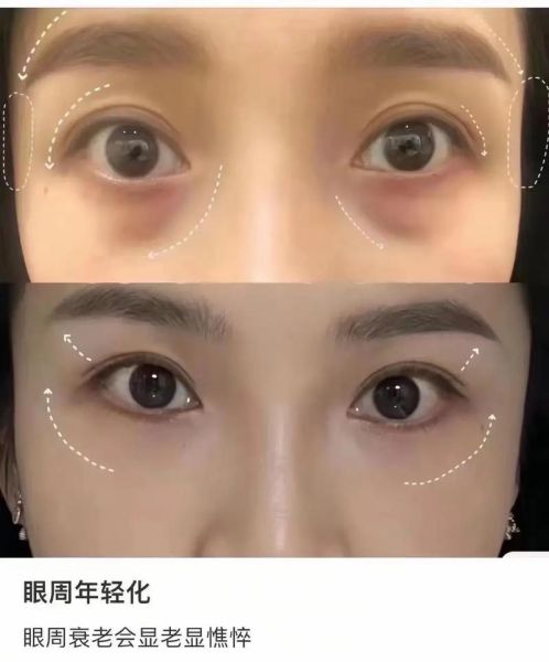 女人黑眼圈严重说明什么_黑眼圈严重怎么办-第2张图片-山城妙识 女人黑眼圈严重说明什么_黑眼圈严重怎么办-第2张图片-山城妙识