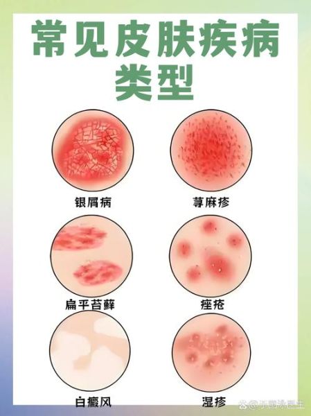 荨麻疹吃什么药好_荨麻疹止痒最快的方法-第3张图片-山城妙识