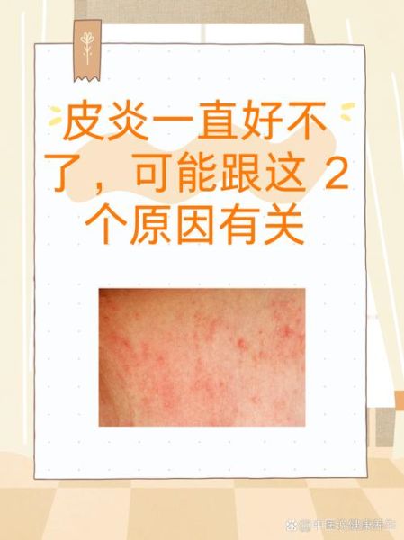 过敏性皮炎图片和症状_怎么判断是不是过敏性皮炎-第2张图片-山城妙识 过敏性皮炎图片和症状_怎么判断是不是过敏性皮炎-第2张图片-山城妙识