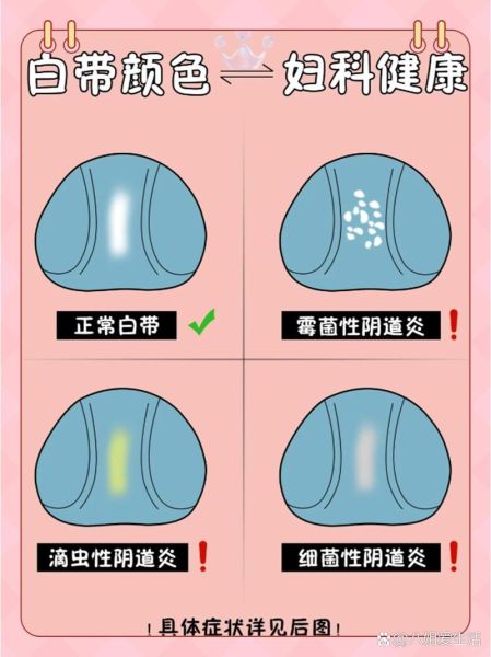 白带豆腐渣状不痒不臭_需要治疗吗-第3张图片-山城妙识 白带豆腐渣状不痒不臭_需要治疗吗-第3张图片-山城妙识