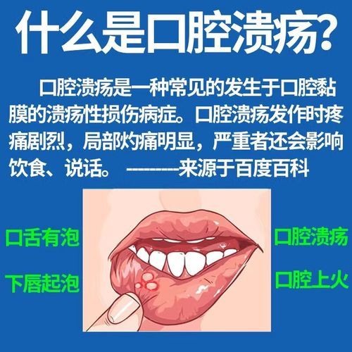 维生素b2治口腔溃疡多久见效_怎么吃最有效-第2张图片-山城妙识