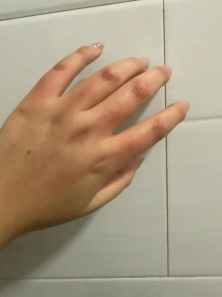 长山药过敏手痒怎么办_长山药手痒怎么快速止痒-第3张图片-山城妙识 长山药过敏手痒怎么办_长山药手痒怎么快速止痒-第3张图片-山城妙识