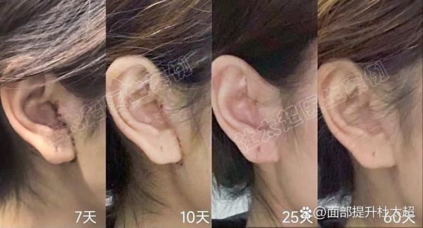 拉皮手术多久恢复自然_拉皮手术恢复期多久-第3张图片-山城妙识 拉皮手术多久恢复自然_拉皮手术恢复期多久-第3张图片-山城妙识