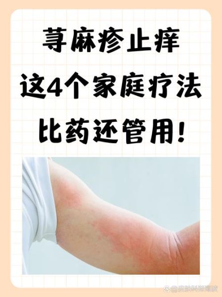 荨麻疹快速止痒小妙招_荨麻疹怎么止痒最快最有效-第3张图片-山城妙识 荨麻疹快速止痒小妙招_荨麻疹怎么止痒最快最有效-第3张图片-山城妙识