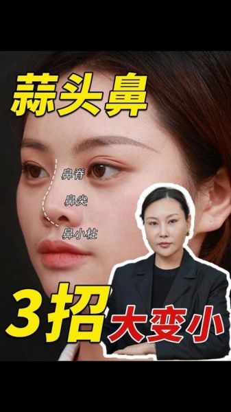 大蒜鼻图片_怎么改善大蒜鼻-第3张图片-山城妙识 大蒜鼻图片_怎么改善大蒜鼻-第3张图片-山城妙识