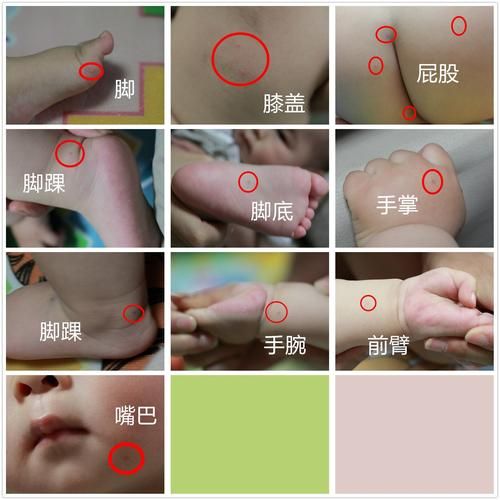 手足口病初期症状图片_如何判断是否感染-第1张图片-山城妙识 手足口病初期症状图片_如何判断是否感染-第1张图片-山城妙识