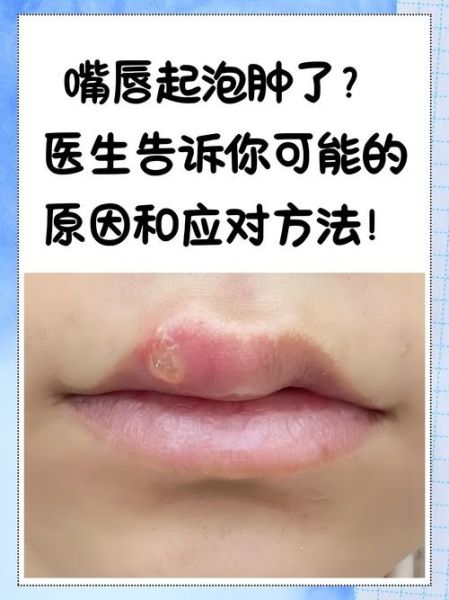 上嘴唇起泡怎么快速消除_上嘴唇起泡是什么原因-第1张图片-山城妙识 上嘴唇起泡怎么快速消除_上嘴唇起泡是什么原因-第1张图片-山城妙识