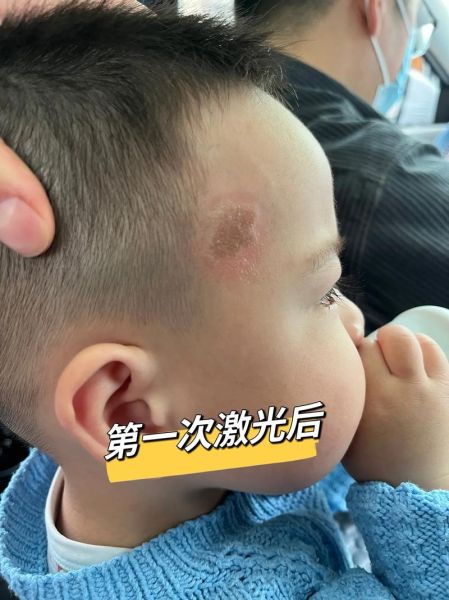 牛奶咖啡斑图片小孩_会自己消失吗-第3张图片-山城妙识