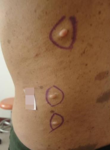 牛奶咖啡斑图片小孩_会自己消失吗-第2张图片-山城妙识