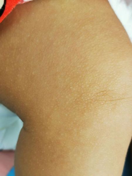 鸡皮疙瘩图片_为什么会起鸡皮疙瘩-第2张图片-山城妙识