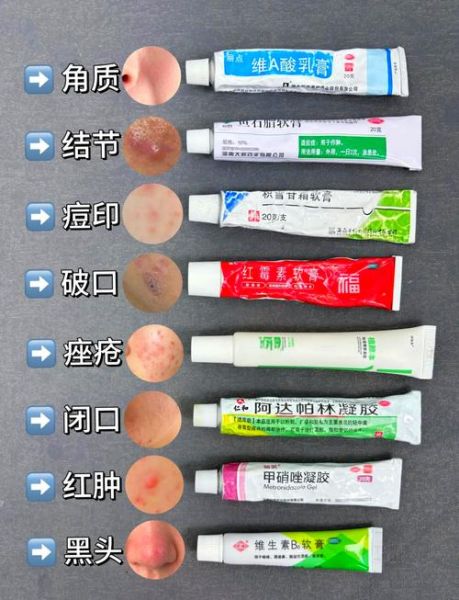 红霉素软膏可以擦脸吗_脸上长痘能用红霉素软膏吗-第1张图片-山城妙识 红霉素软膏可以擦脸吗_脸上长痘能用红霉素软膏吗-第1张图片-山城妙识