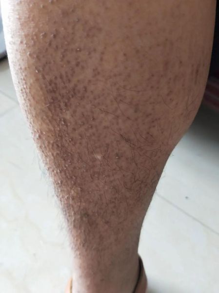 淀粉样变皮肤病怎么治疗_能根治吗-第1张图片-山城妙识 淀粉样变皮肤病怎么治疗_能根治吗-第1张图片-山城妙识