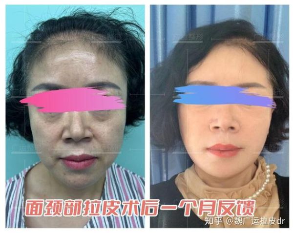 拉皮除皱能维持多久_拉皮除皱术后多久恢复自然-第1张图片-山城妙识 拉皮除皱能维持多久_拉皮除皱术后多久恢复自然-第1张图片-山城妙识