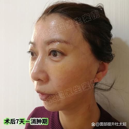 拉皮除皱能维持多久_拉皮除皱术后多久恢复自然-第2张图片-山城妙识 拉皮除皱能维持多久_拉皮除皱术后多久恢复自然-第2张图片-山城妙识
