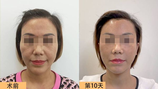拉皮除皱能维持多久_拉皮除皱术后多久恢复自然-第3张图片-山城妙识 拉皮除皱能维持多久_拉皮除皱术后多久恢复自然-第3张图片-山城妙识