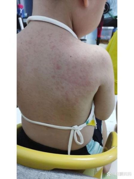 蚕豆过敏症状_蚕豆病不能吃蚕豆吗-第1张图片-山城妙识 蚕豆过敏症状_蚕豆病不能吃蚕豆吗-第1张图片-山城妙识