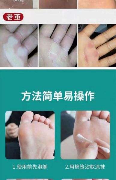 鸡眼怎么去除_鸡眼贴有用吗-第1张图片-山城妙识