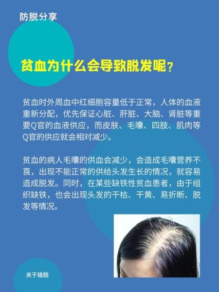 贫血会导致脱发吗_贫血脱发怎么办-第2张图片-山城妙识 贫血会导致脱发吗_贫血脱发怎么办-第2张图片-山城妙识