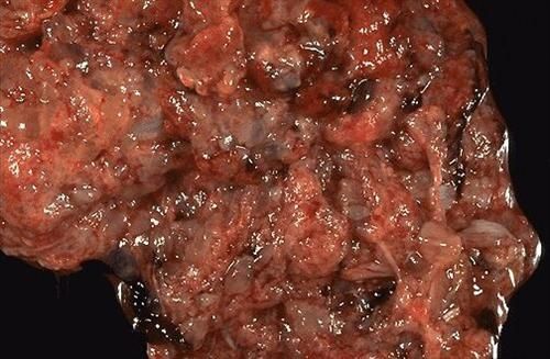 葡萄胎图片_如何识别葡萄胎早期症状-第2张图片-山城妙识 葡萄胎图片_如何识别葡萄胎早期症状-第2张图片-山城妙识