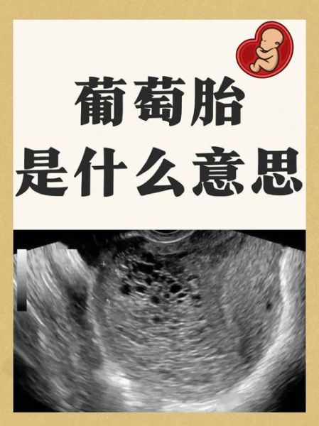 葡萄胎图片_如何识别葡萄胎早期症状-第1张图片-山城妙识 葡萄胎图片_如何识别葡萄胎早期症状-第1张图片-山城妙识