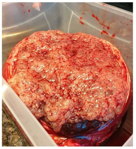 葡萄胎图片_如何识别葡萄胎早期症状-第3张图片-山城妙识 葡萄胎图片_如何识别葡萄胎早期症状-第3张图片-山城妙识