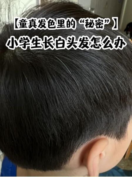 白头发怎么治_最简单的方法是什么-第3张图片-山城妙识