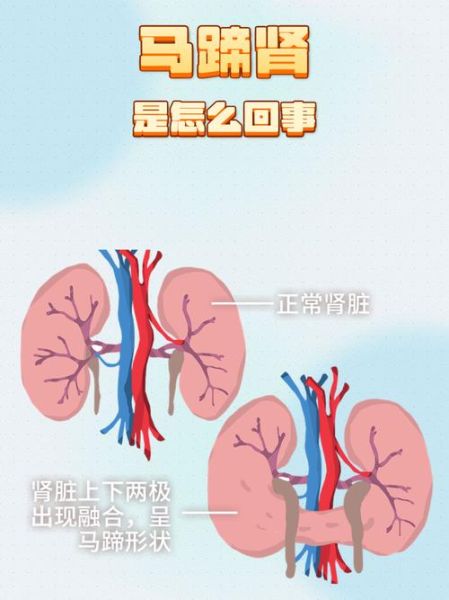 马蹄肾能活多久_马蹄肾人均寿命-第2张图片-山城妙识