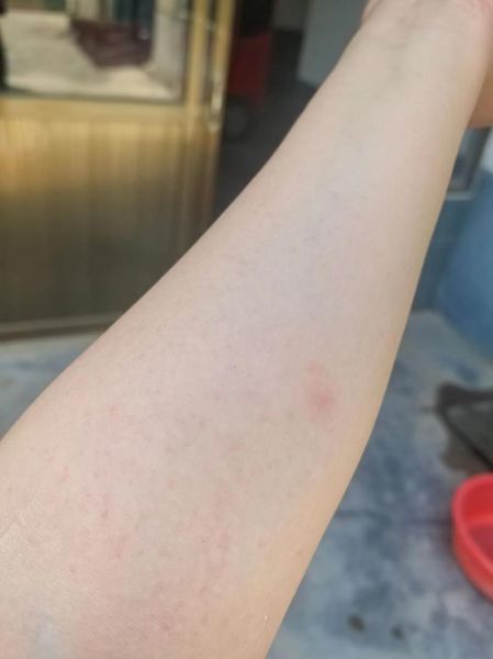 海鲜过敏快速止痒_海鲜过敏痒多久能好-第3张图片-山城妙识 海鲜过敏快速止痒_海鲜过敏痒多久能好-第3张图片-山城妙识