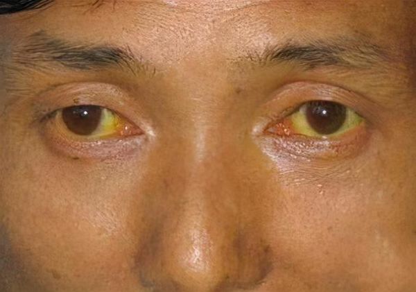 肝病脸上有什么症状_肝病面部图片对照-第2张图片-山城妙识 肝病脸上有什么症状_肝病面部图片对照-第2张图片-山城妙识