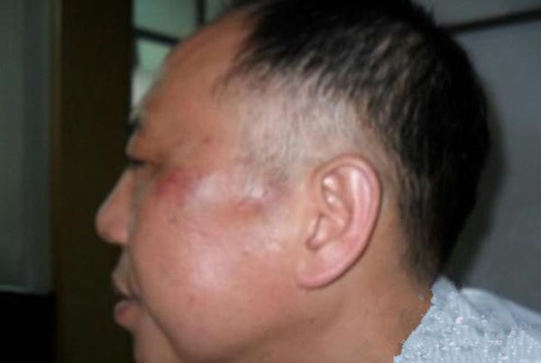 肝病脸上有什么症状_肝病面部图片对照-第3张图片-山城妙识 肝病脸上有什么症状_肝病面部图片对照-第3张图片-山城妙识