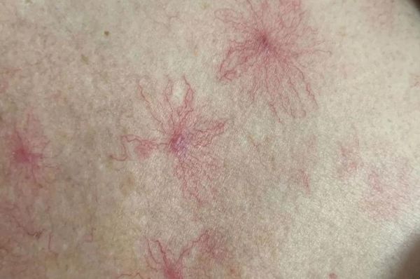 肝病脸上有什么症状_肝病面部图片对照-第1张图片-山城妙识 肝病脸上有什么症状_肝病面部图片对照-第1张图片-山城妙识