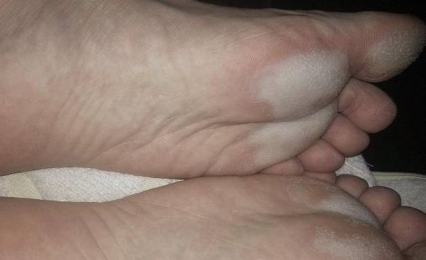 得了肝病脚先知道_肝病早期脚部信号有哪些-第2张图片-山城妙识 得了肝病脚先知道_肝病早期脚部信号有哪些-第2张图片-山城妙识