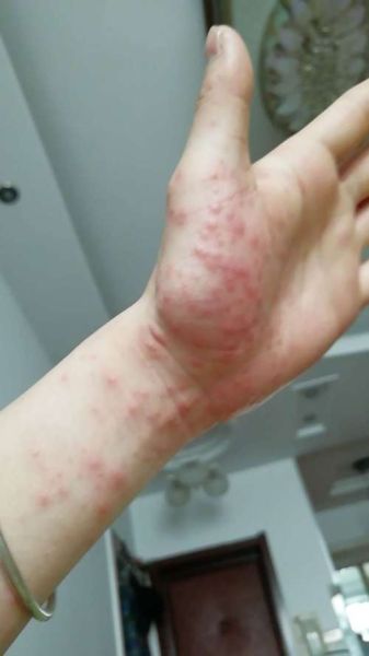 怎么判断自己海鲜过敏_海鲜过敏症状有哪些-第3张图片-山城妙识 怎么判断自己海鲜过敏_海鲜过敏症状有哪些-第3张图片-山城妙识