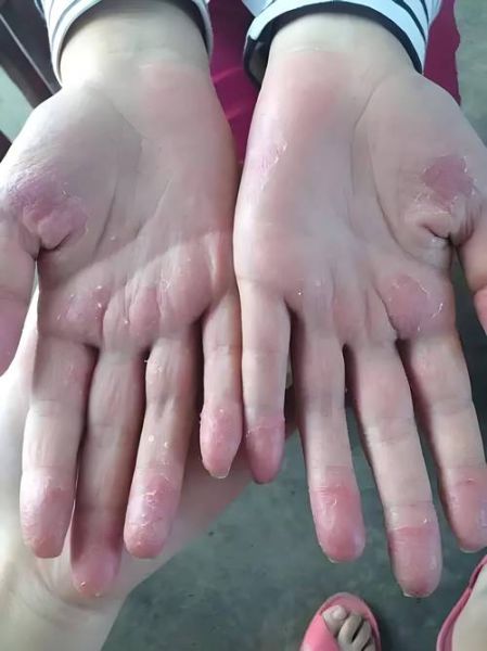 白果皮手脱皮怎么办_白果皮过敏症状-第2张图片-山城妙识