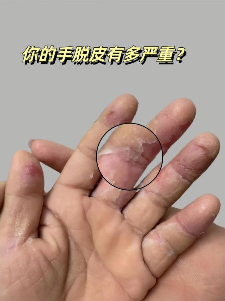 白果皮手脱皮怎么办_白果皮过敏症状-第3张图片-山城妙识