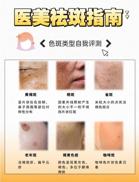 用什么可以祛斑_祛斑最有效的方法是什么-第1张图片-山城妙识
