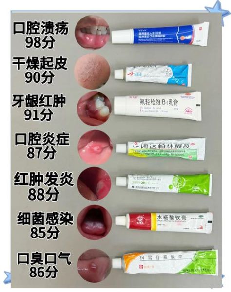口腔溃疡吃什么药好使_口腔溃疡多久能好-第1张图片-山城妙识