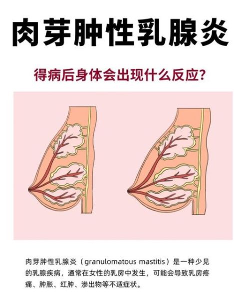 乳腺增生症状图片_乳腺增生有哪些典型表现-第3张图片-山城妙识 乳腺增生症状图片_乳腺增生有哪些典型表现-第3张图片-山城妙识