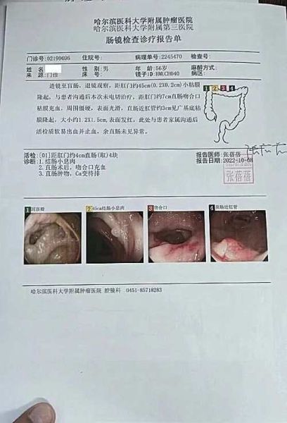 直肠癌晚期能治好吗_晚期直肠癌治愈案例-第1张图片-山城妙识