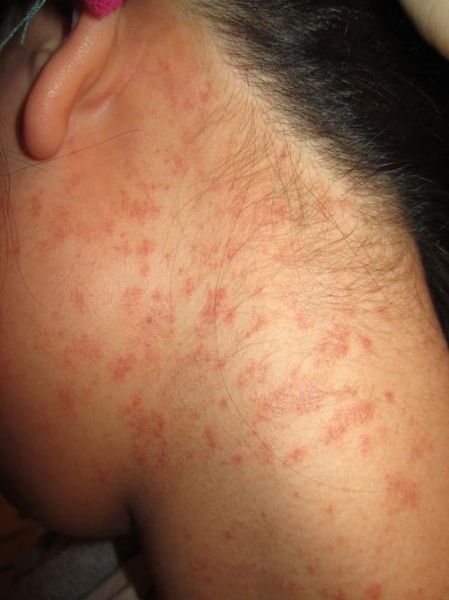 蔓越莓过敏症状有哪些_蔓越莓过敏图片怎么看-第1张图片-山城妙识