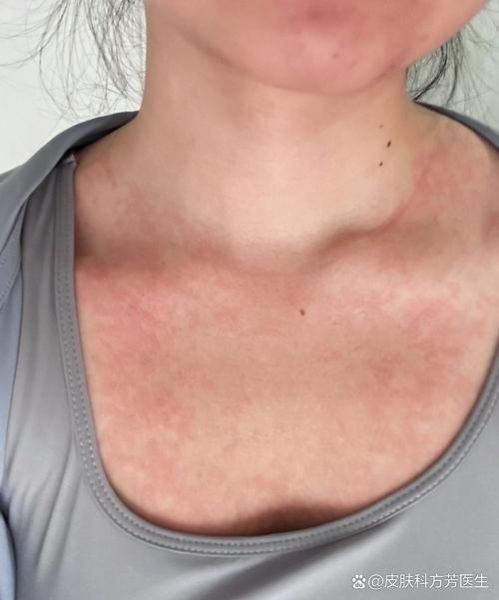 蔓越莓过敏症状有哪些_蔓越莓过敏图片怎么看-第3张图片-山城妙识