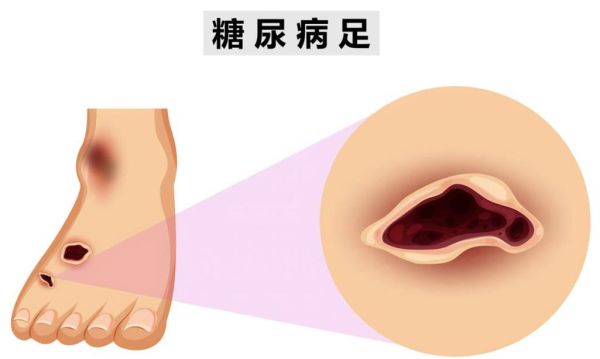 女性糖尿病有什么反应_早期症状有哪些-第3张图片-山城妙识 女性糖尿病有什么反应_早期症状有哪些-第3张图片-山城妙识