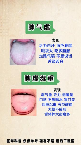 齿痕舌是脾气虚还是脾阳虚_如何区分与调理-第1张图片-山城妙识 齿痕舌是脾气虚还是脾阳虚_如何区分与调理-第1张图片-山城妙识