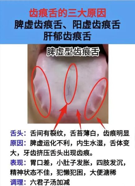 齿痕舌是脾气虚还是脾阳虚_如何区分与调理-第2张图片-山城妙识 齿痕舌是脾气虚还是脾阳虚_如何区分与调理-第2张图片-山城妙识