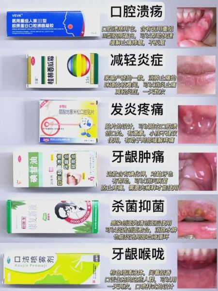 嘴巴长溃疡怎么快速好_嘴巴溃疡吃什么好得快-第1张图片-山城妙识