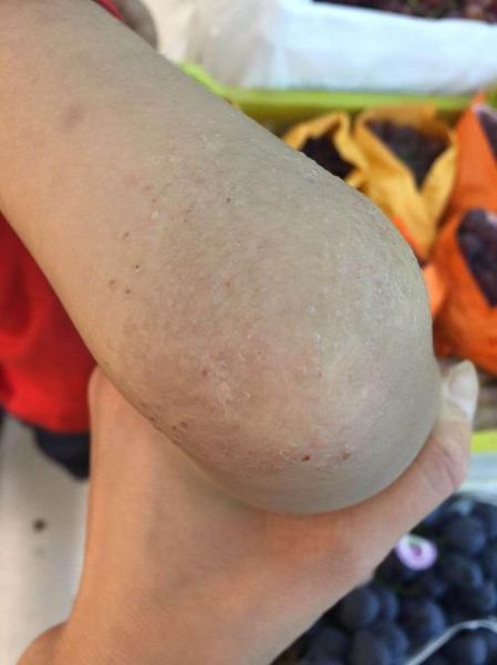 吃螃蟹过敏的症状_多久能好-第3张图片-山城妙识