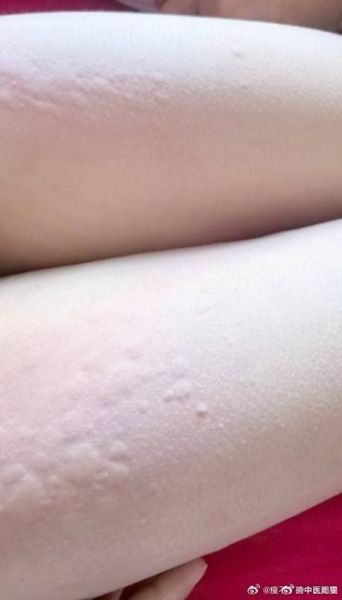 吃螃蟹过敏的症状_多久能好-第2张图片-山城妙识