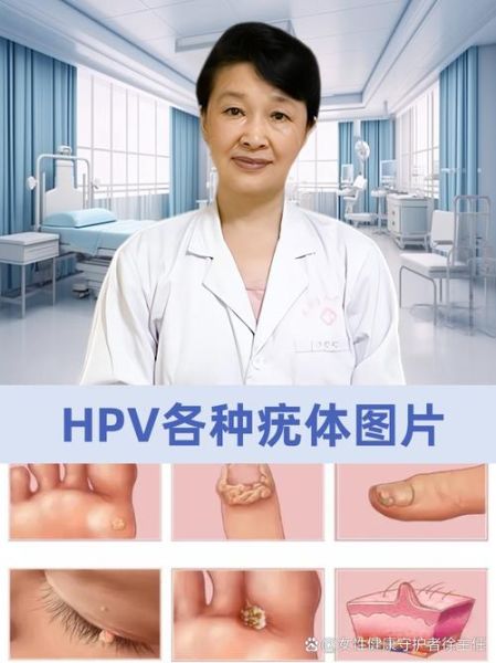 菜花状赘生物图片_是尖锐湿疣吗-第3张图片-山城妙识