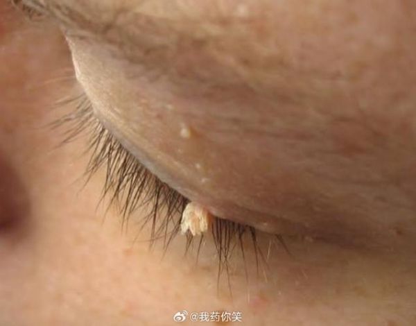 菜花状赘生物图片_是尖锐湿疣吗-第2张图片-山城妙识